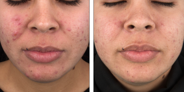 Acne - The Whole Story! - Dermaquest