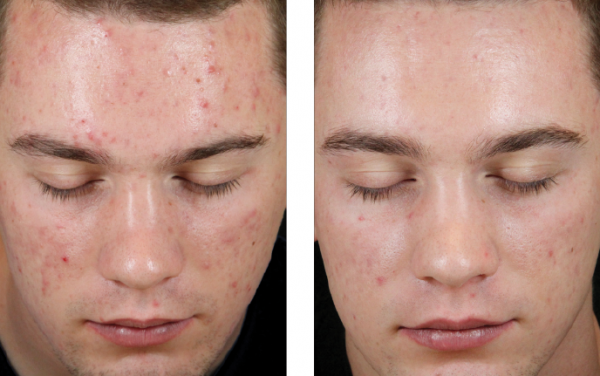 Acne - The Whole Story! - Dermaquest