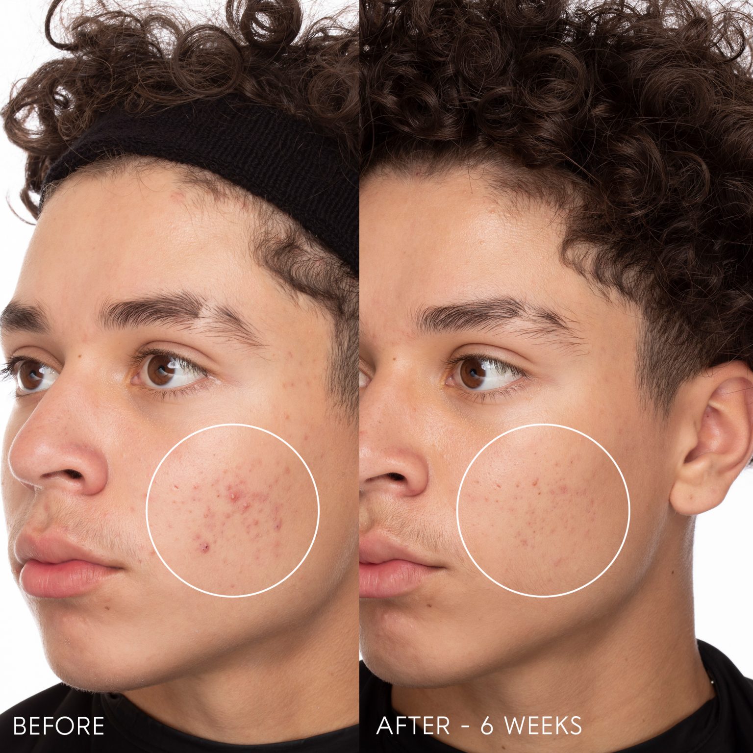 Advanced DermaClear Serum - Dermaquest